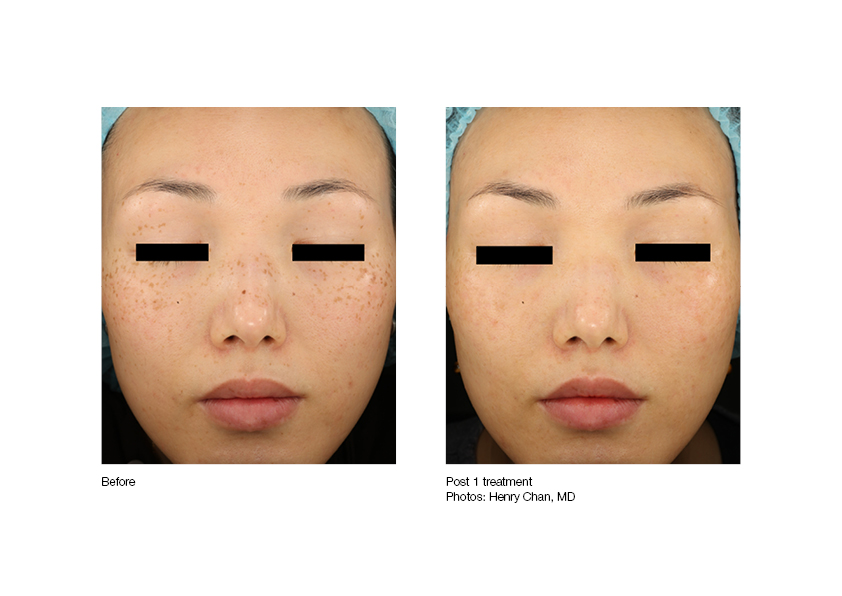 Syneron Announces Launch of PicoWay Picosecond Device for Pigmented ...