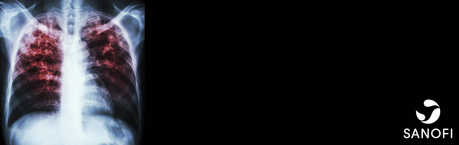 Sanofi Launches New Priftin® (Rifapentine) Packaging