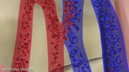 Kidney Patients Report Positive Experiences with Novel Approach to Dialysis