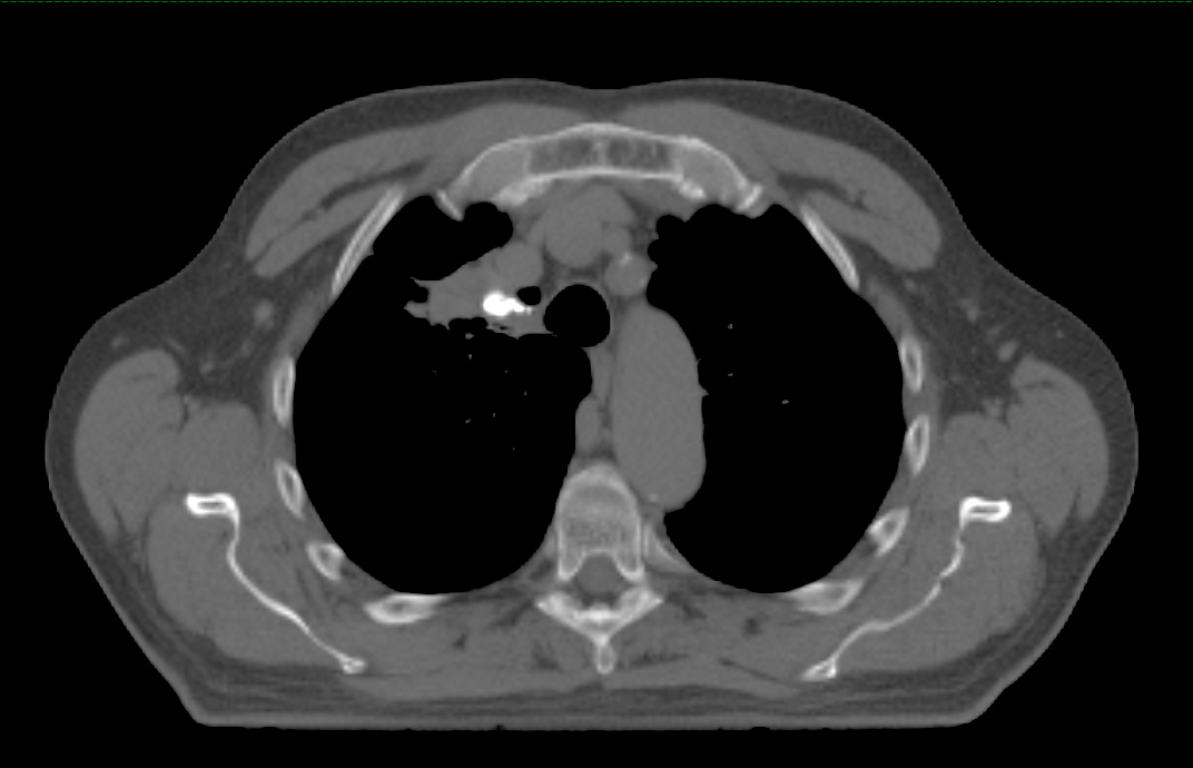 Nanovi Launch Novel Liquid Soft Tissue Marker: BioXmark®